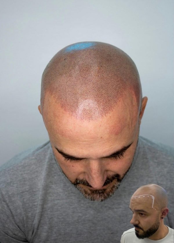 Scalp Micropigmentation and Beard | Hair Restoration | London ...