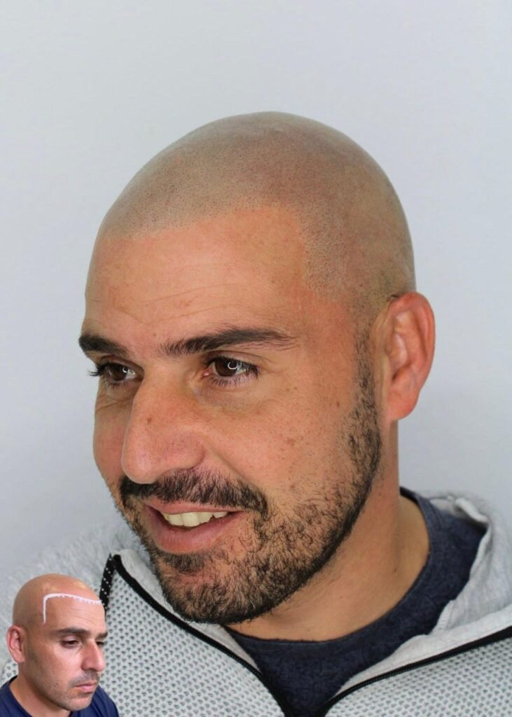 Scalp Micropigmentation and Beard | Hair Restoration | London ...