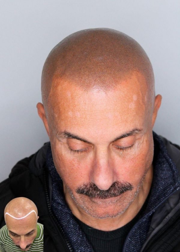 Scalp Micropigmentation and Beard | Hair Restoration | London ...