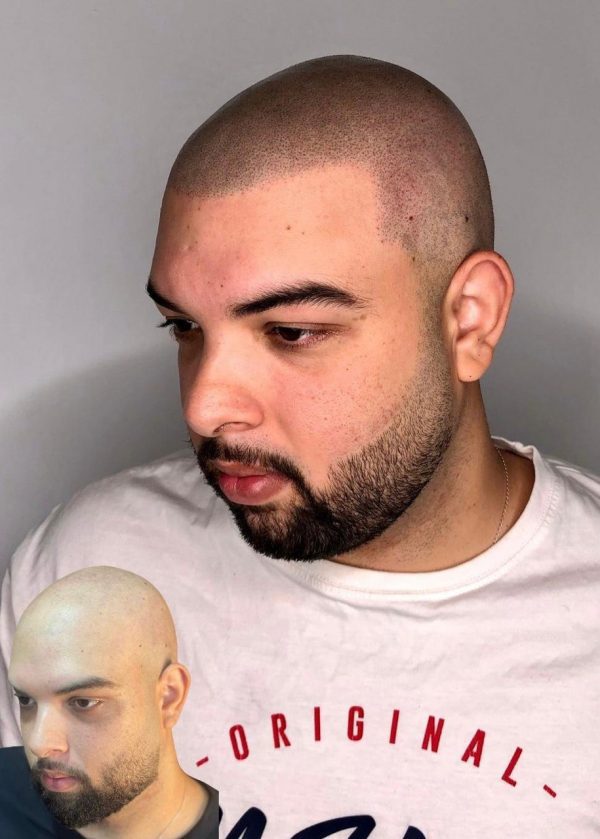 Scalp Micropigmentation and Beard | Hair Restoration | London ...