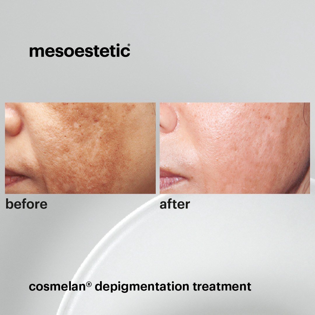 Cosmelan Peel for Radiant Skin | London Aesthetics Clinic