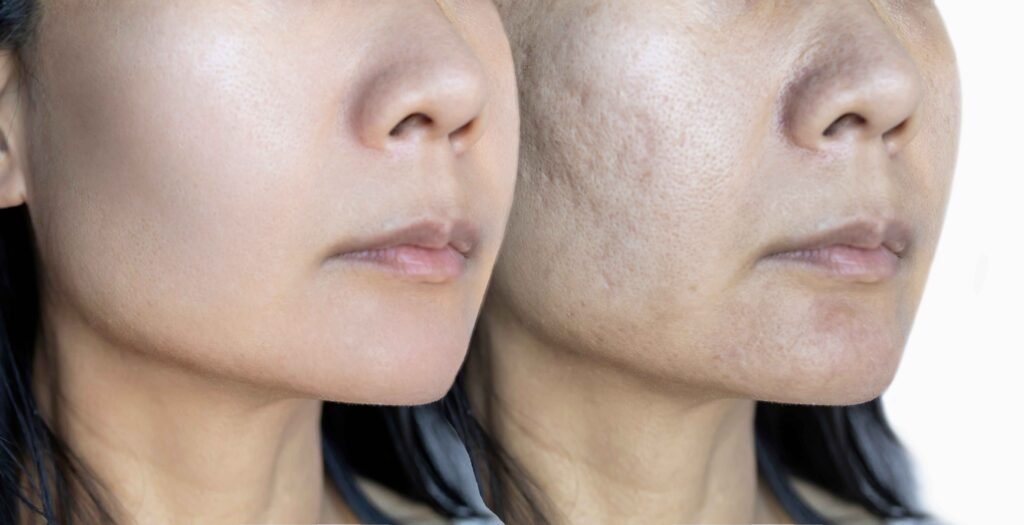 Vampire Face Lift | Rejuvenating Treatment | London Aesthetics Clinic